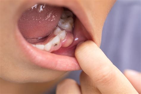 6 Facts You Didnt Know About Cavities Port Pediatric Dentistry