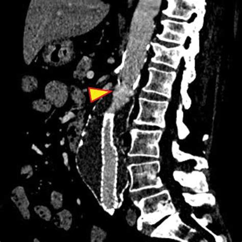 The Juxtarenal Aortic Aneurysm Of Case 2 The Arrowhead Shows The Pair