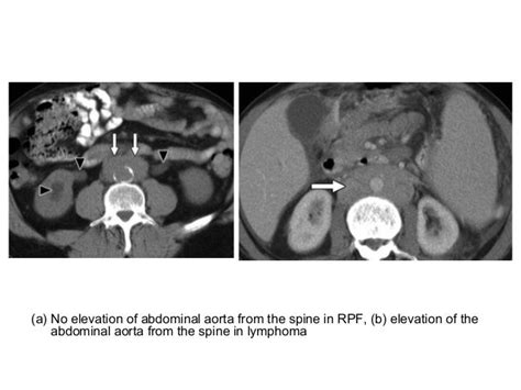 Diagnostic Imaging Of Perinephric Space