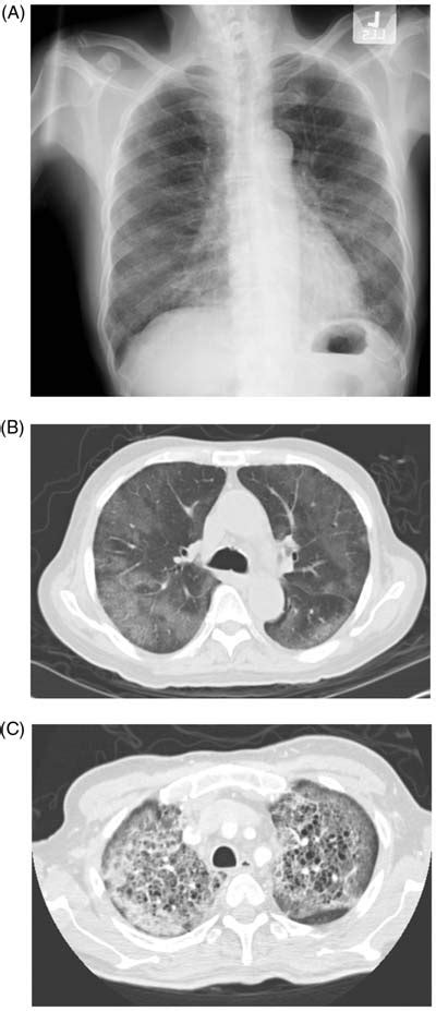 Chest Radiograph Showing Diffuse Patchy Bilateral Inte
