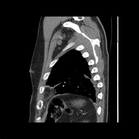 Acute Epicardial Fat Necrosis Image