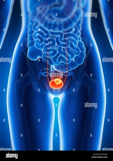 Bladder Cancer Hi Res Stock Photography And Images Alamy