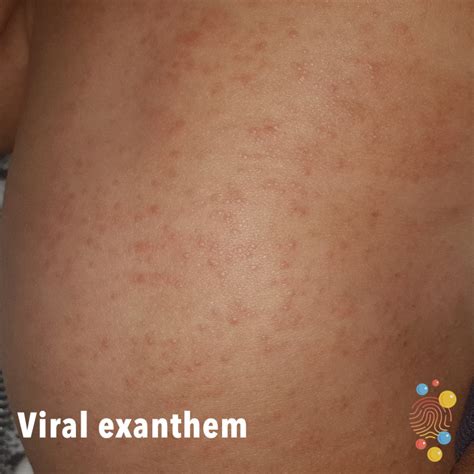 212 Images Of Viral Rashes MyWeb