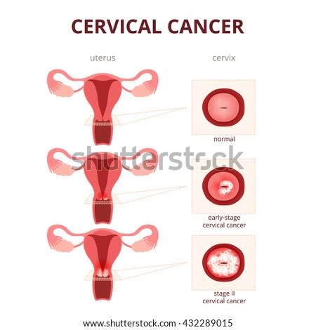 Cervical Erosion Schematic Illustration Uterus Cervix Stock Vector