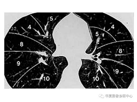 胸部ct基本读片知识概述 医学界 助力医生临床决策和职业成长