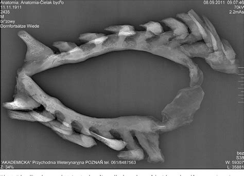 Cervical Ectopia Cordis Semantic Scholar