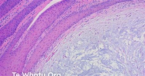 Dermnet® Digital Myxoid Pseudocyst Pathology Image