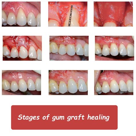 Stages Of Gum Graft Healing