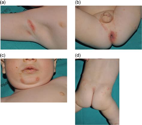 Erythematous Well‐defined Exudative Plaques On The Axillary Folds A