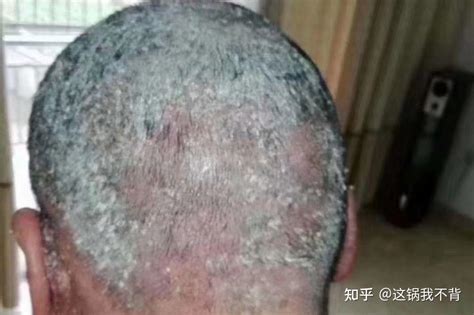 中药治好了我二十年的牛皮癣（银屑病）（对比图可能引起不适，慎点） 知乎