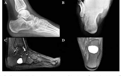 Unicameral Bone Cyst Calcaneus Surgery Unicameral Bone Cyst Calcaneus Surgery
