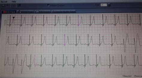 Looks Like Normal Sinus Rhythm Mostly But What Are The Two Beats Far