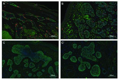 Immunofluorescence Examples Of Section From Bcc Cases With Aggressive Download Scientific