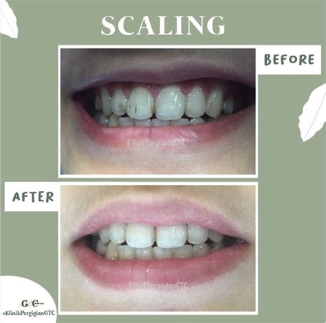 Scaling Gtc Dental Ipoh Garden