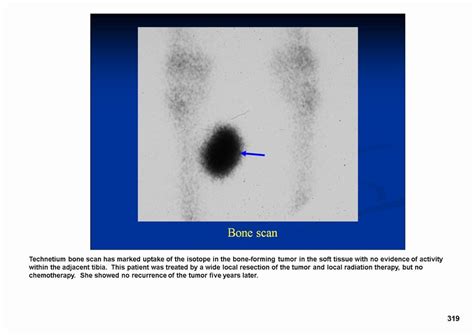 Soft Tissue Osteosarcoma An Atlas Of Musculoskeletal Oncology
