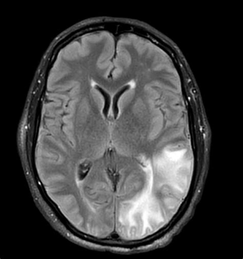 Cyclosporine Induced Posterior Reversible Encephalopathy Syndrome An