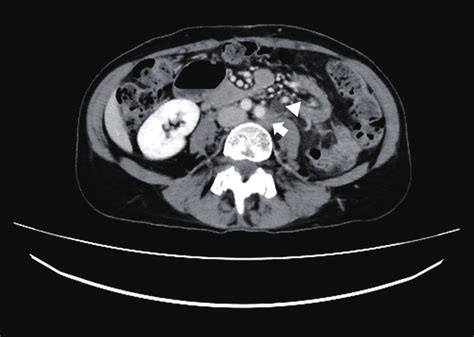 A Transverse View On Cect Scan Showed Left Common Iliac Lymph Node Download Scientific Diagram