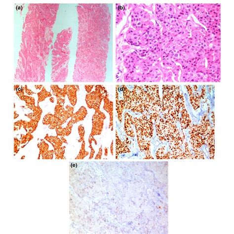A Low Power Magnification View Of Trucut Axillary Lymph Node Biopsy Download Scientific