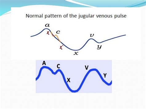 Jugular Venous Pressure