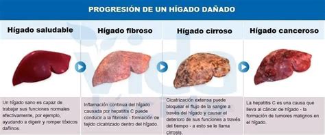 Signos De Un Hígado Dañado