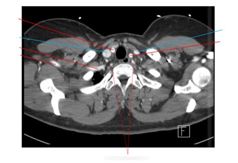 Ct Image 4 Vessels Diagram Quizlet