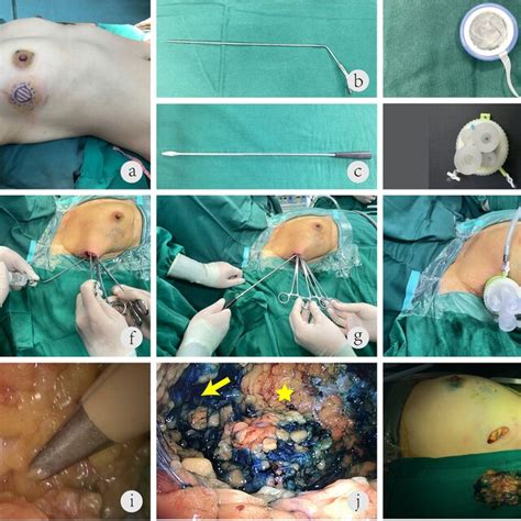 A Injection Of Methylene Blue To Identify Sentinel Lymph Nodes And