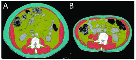Evaluation Of Body Composition An Axial Ct Image Segmented Into The Download Scientific
