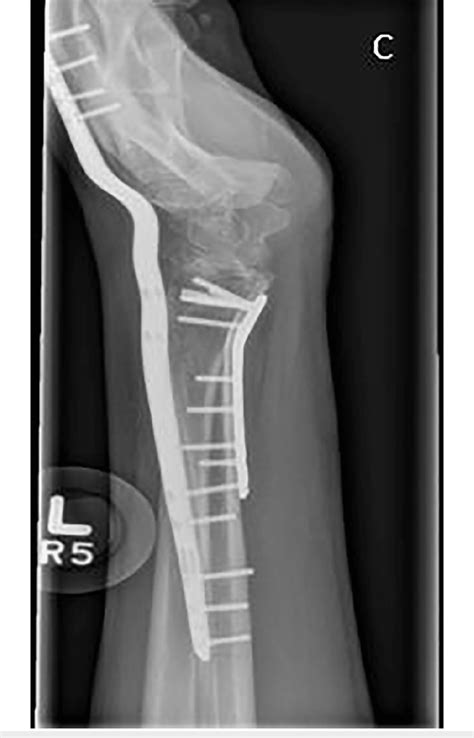 Lateral Radiograph After The First Stage Of Surgery Length Alignment