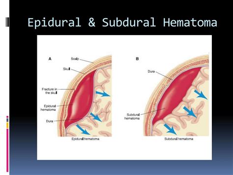 Ppt Concussions Powerpoint Presentation Free Download Id 2856171