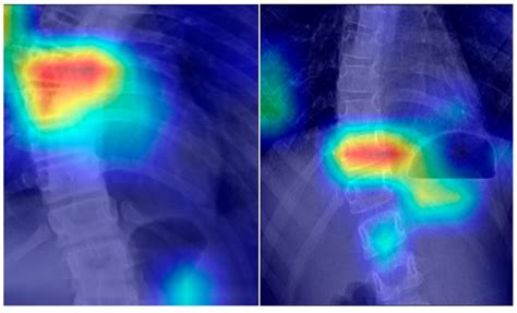 Lenke Classification Report Generation Method For Scoliosis Based On Spatial And Context Dual