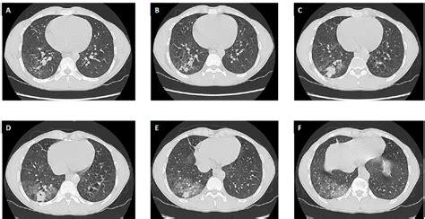 Figure 1 From How We Treat Drug Susceptible Pulmonary Tuberculosis A