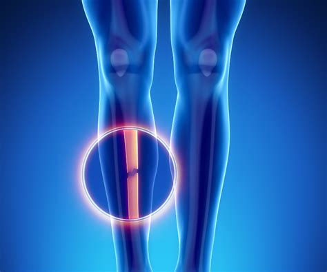 Cracks Vs Breaks Sk Radiology