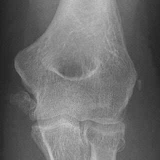 Postoperative Anteroposterior Radiograph Of The Elbow Showing Complete