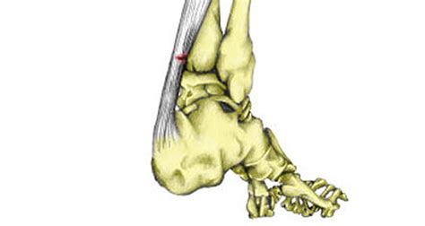 Partial Rupture Of Achilles Tendon Symptoms Causes And Treatment