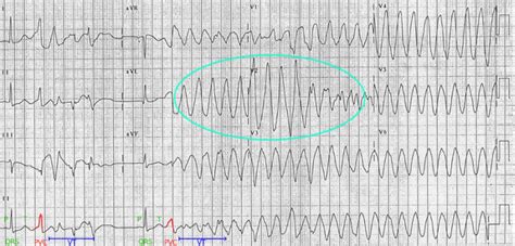 Pulseless Ventricular Tachycardia Ecg
