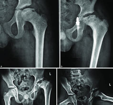 Natural Course Of A Late Presentation Of Perthes Disease A X Ray Download Scientific Diagram