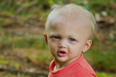 20 Facts About Total Hypotrichosis