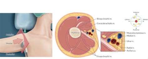 Upper Extremity Blocks Flashcards Quizlet