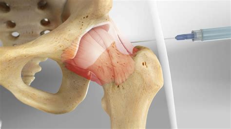 Hip Joint Injection The Spine Institute Murray Utah