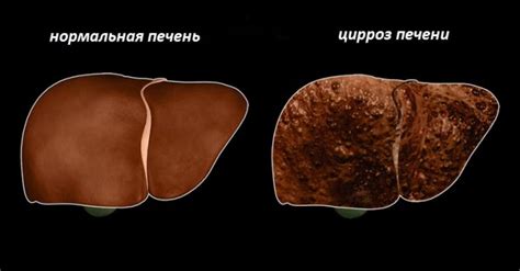 цирроз печени 4 стадия сколько живут с таким диагнозом