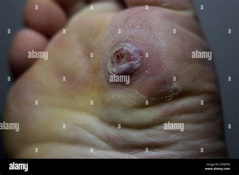 Foot Infection Planters Wart And Blister After Freezing With Liquid