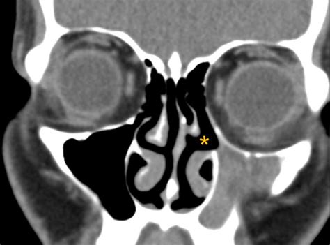 The Opacified Paranasal Sinus Approach And Differential Applied