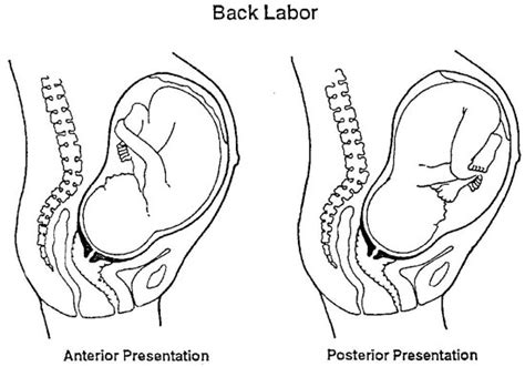 What Does Back Labor Feel Like New Health Advisor