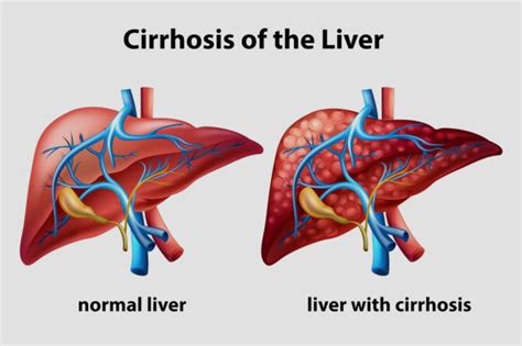 Liver Transplant After Cirrhosis When Is The Right Time Dr Pathik