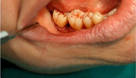 Single Interrupted Suture On Tooth 47 Download Scientific Diagram