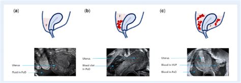 Semi Quantitative Grading Of Haemoperitoneum A Mild B Moderate
