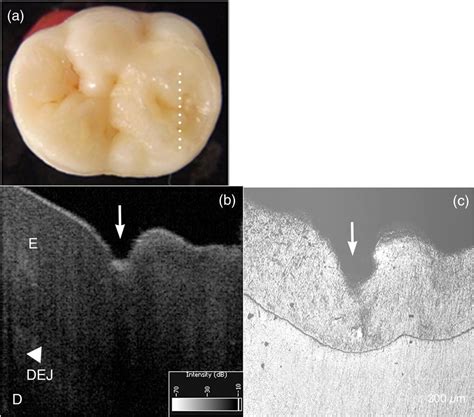 Detection Of Occlusal Caries In Primary Teeth Using Swept Source Optical Coherence Tomography