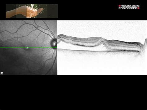Spectralis Oct Normal Anatomy And Systematic Interpretation Pdf Eye And Vision Conditions