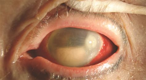 Infections Caused By Exogenous Bacteria Localised Infections