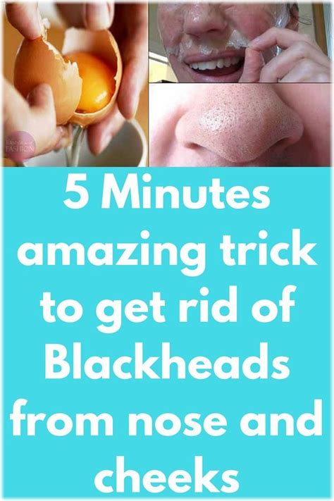 How To Get Rid Of Blackheads Oily Skin More More Artofit